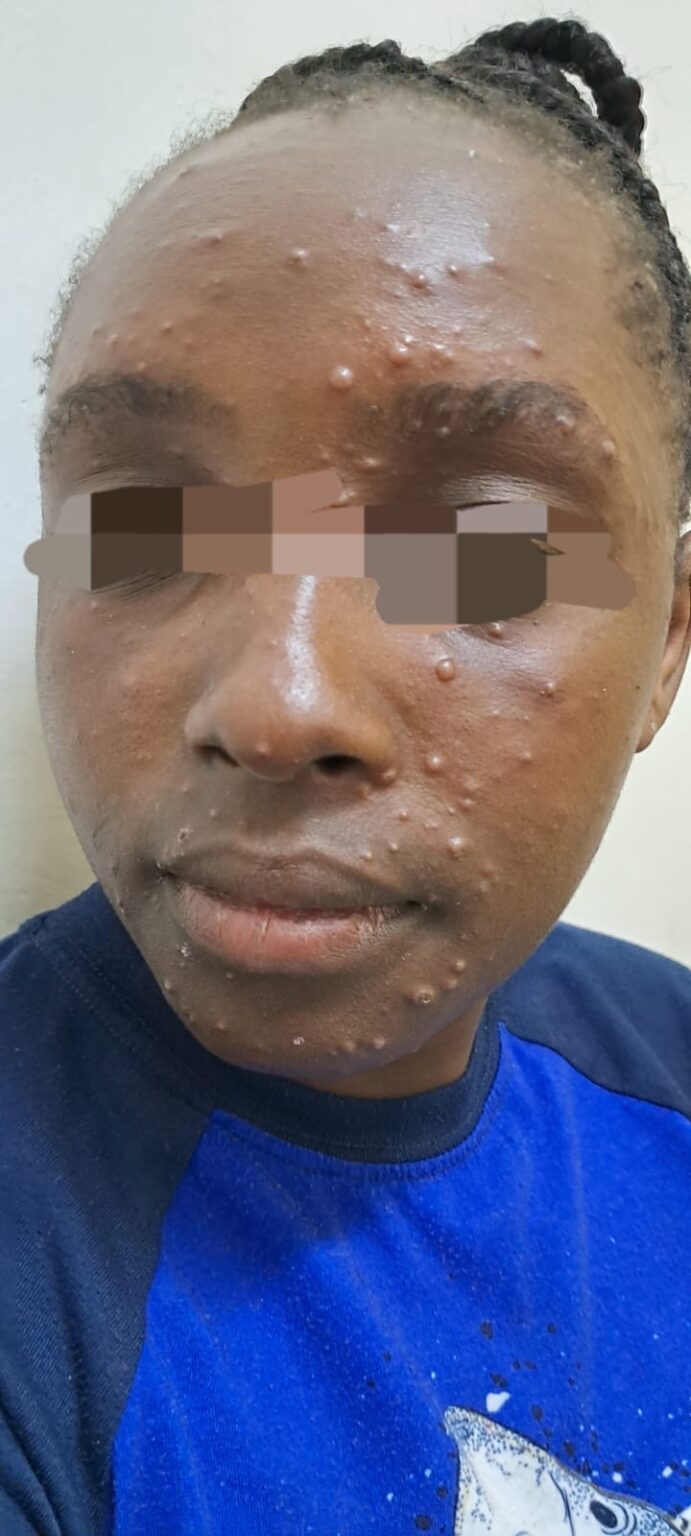 Ministry of Health Reports No New Suspected Mpox Cases in Latest Update ...